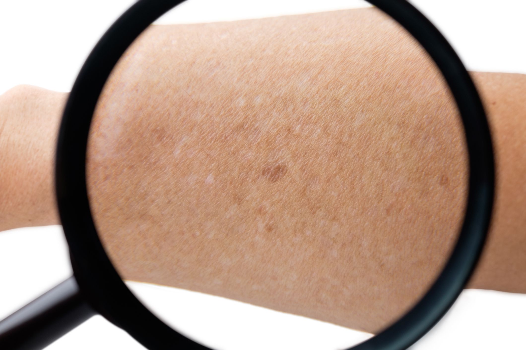 Pigmentation corps : dos /bras / jambes - Plasma+