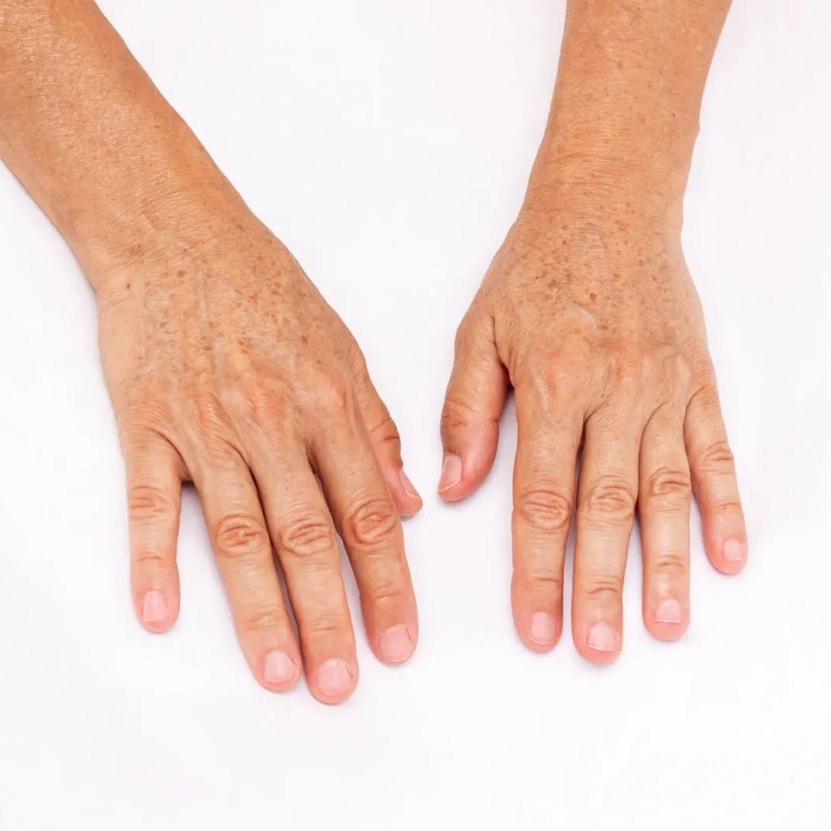 Tache pigmentaire des mains - Plasma Clinic