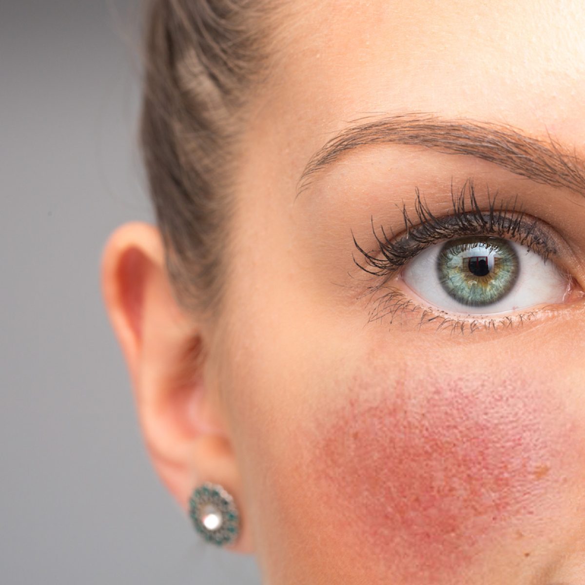 Rougeur visage : rosacée/dermites séborrhéique - Plasma Clinic